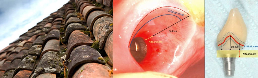 emergence profile – Implant + Dentistry – Nikos Mattheos