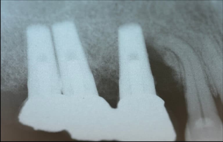 From Friction Stability to Osseointegration and all things in-between ...