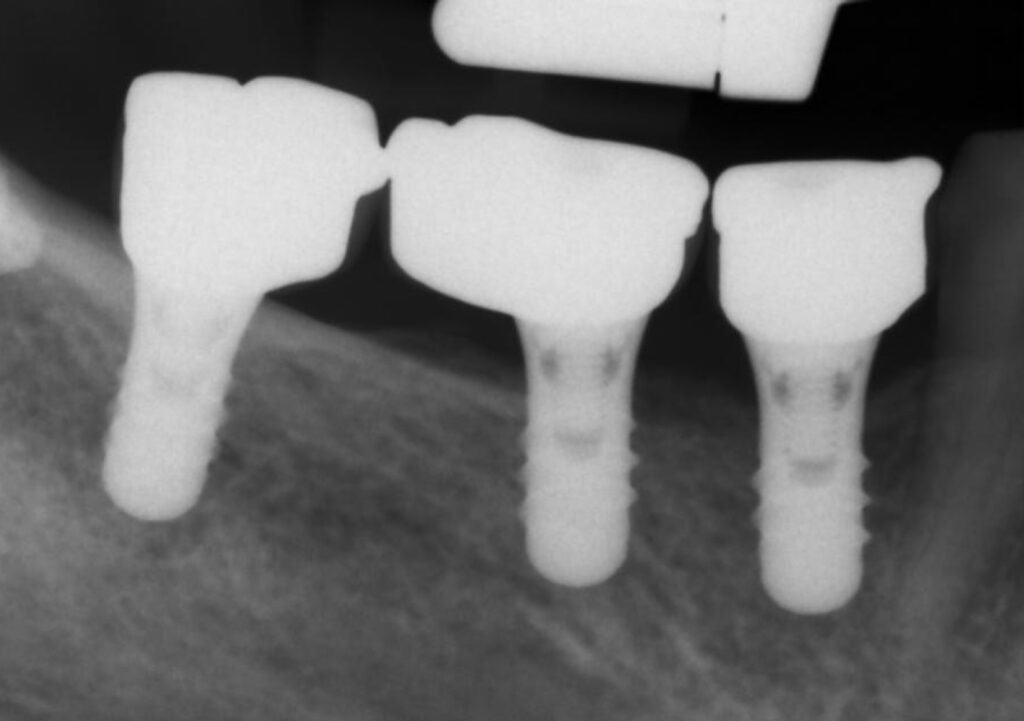 Tissue Level versus Bone Level implants: Vol. 2 ! – Implant + Dentistry ...
