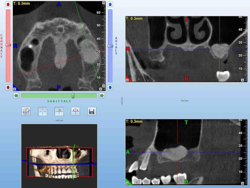Implant Surgery with map and compass! – Implant + Dentistry – Nikos ...