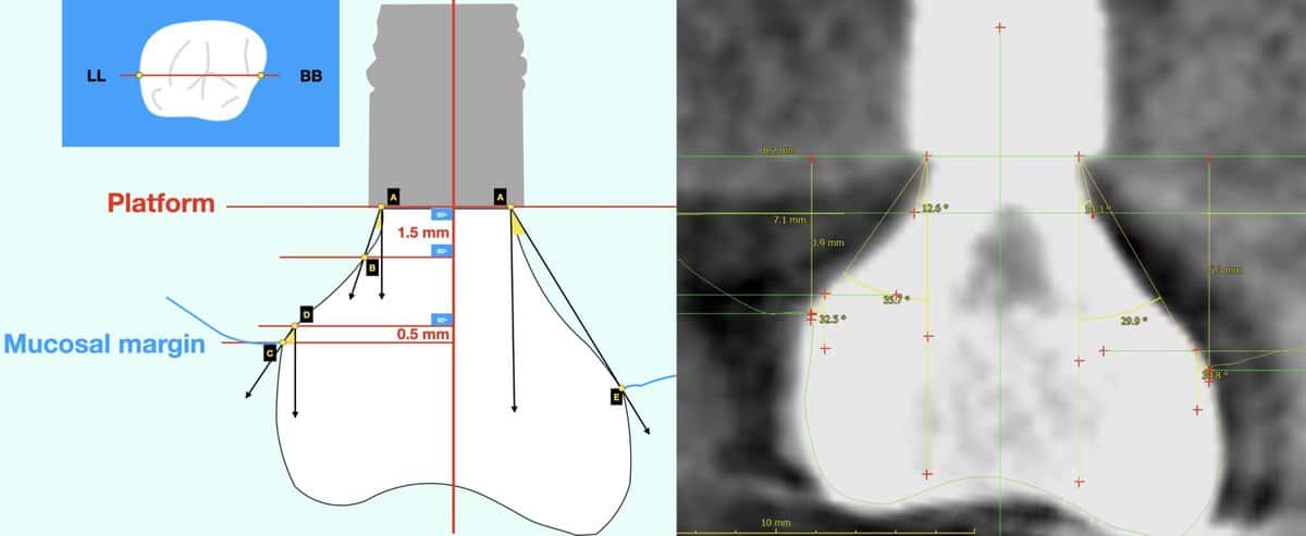 Implant Emergence Profile Demystified – Implant + Dentistry – Nikos Mattheos