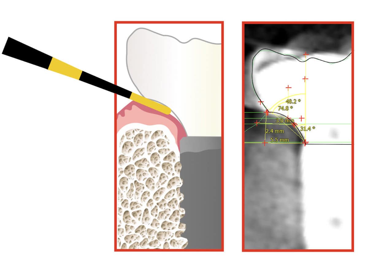 Implant Emergence Profile Demystified – Implant + Dentistry – Nikos ...